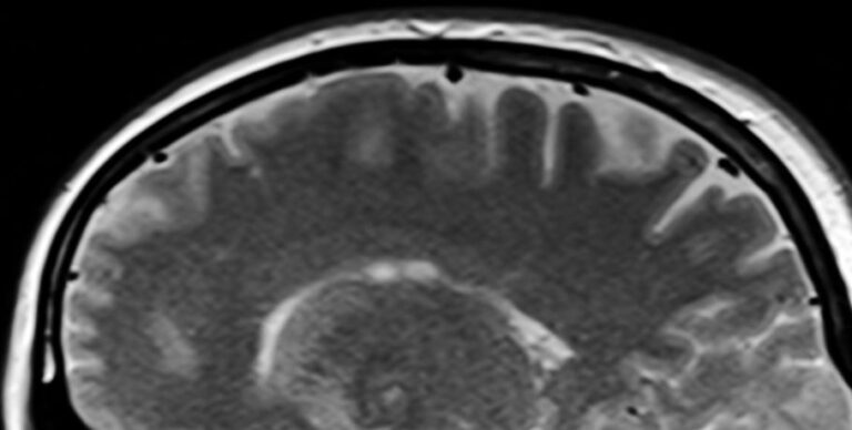 Hersenletsel als gevolg van een aanrijding of ongeluk